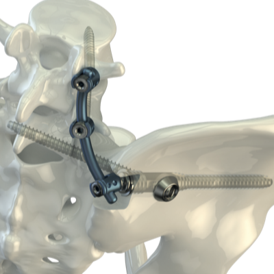 VERTICALE Triangular Fixation Screws | USS MEDICAL WEB PORTAL